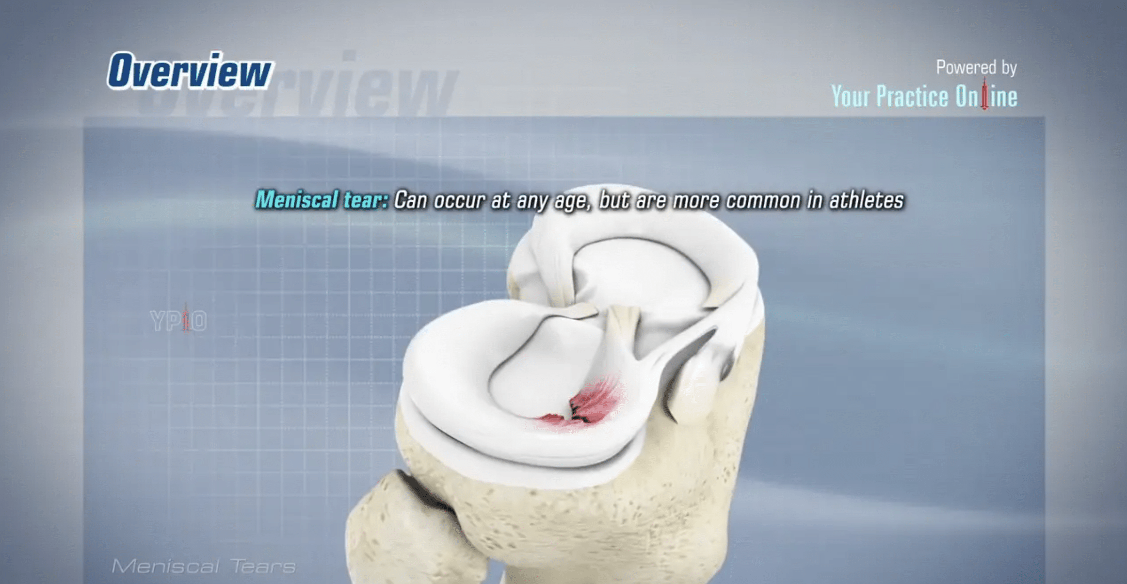 Meniscal Tears - Michigan Knee Institute